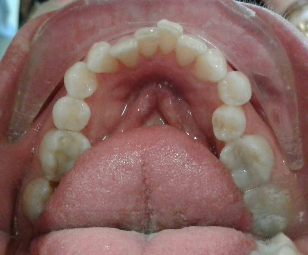 Invisalign Lite - Express Treatment - Invisible Clear Braces